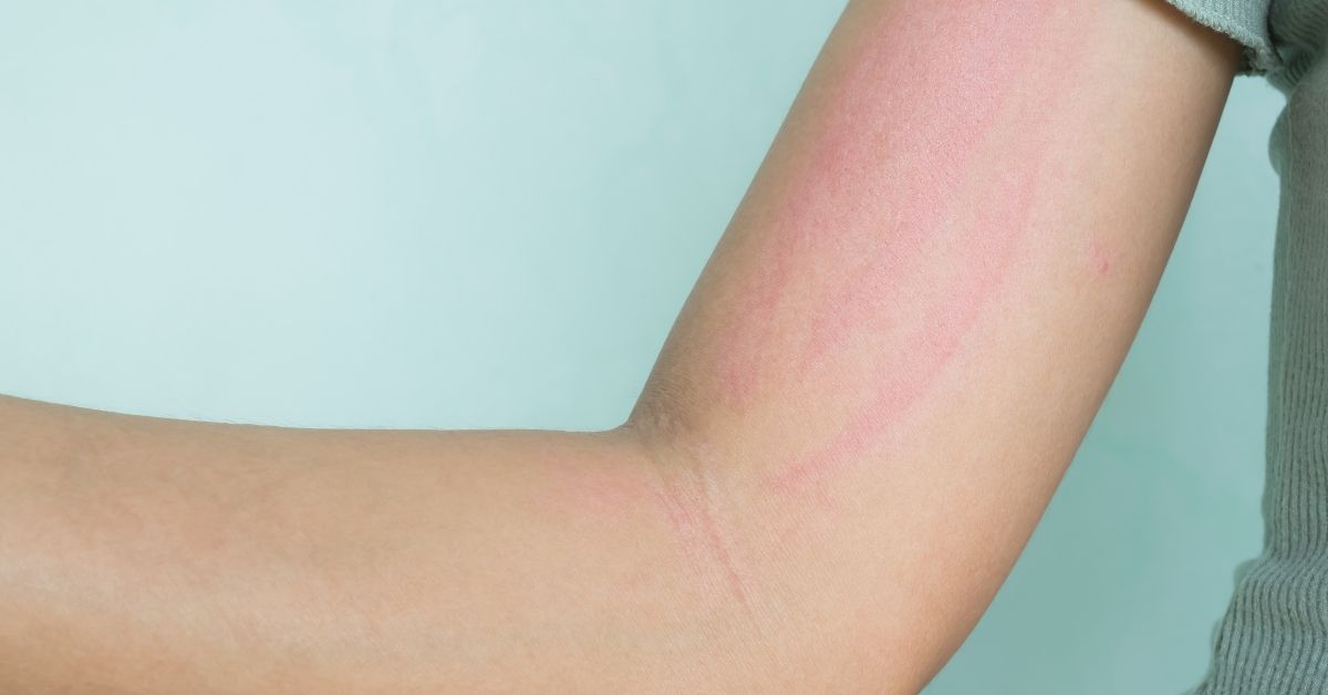 Orticaria dermografica (Dermografismo): cause, sintomi e cure